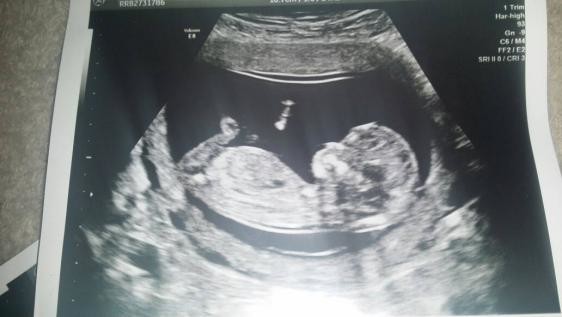 Early scan at 6 weeks, show me your pics!