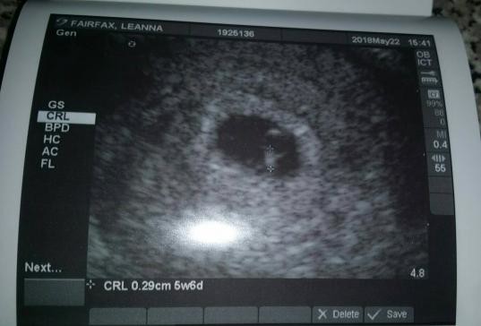 Early scan at 6 weeks, show me your pics!