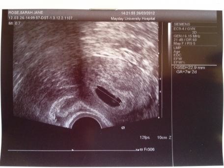 Early Scan Photos, Does this look right for 5 and half weeks?