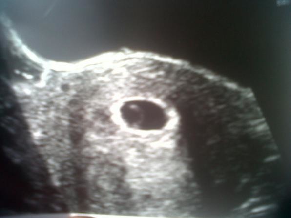 Early Scan Photos, Does this look right for 5 and half weeks?