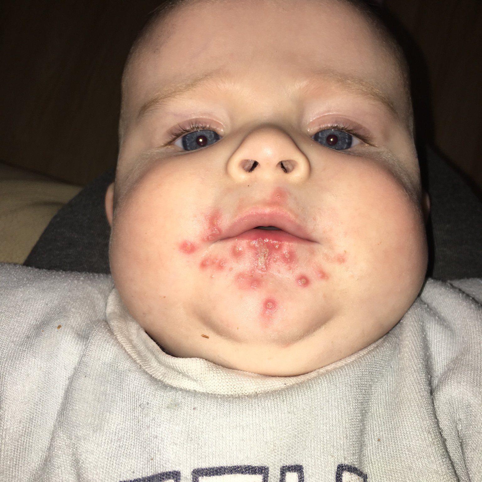 Angry spots round mouth that burst and are spreading