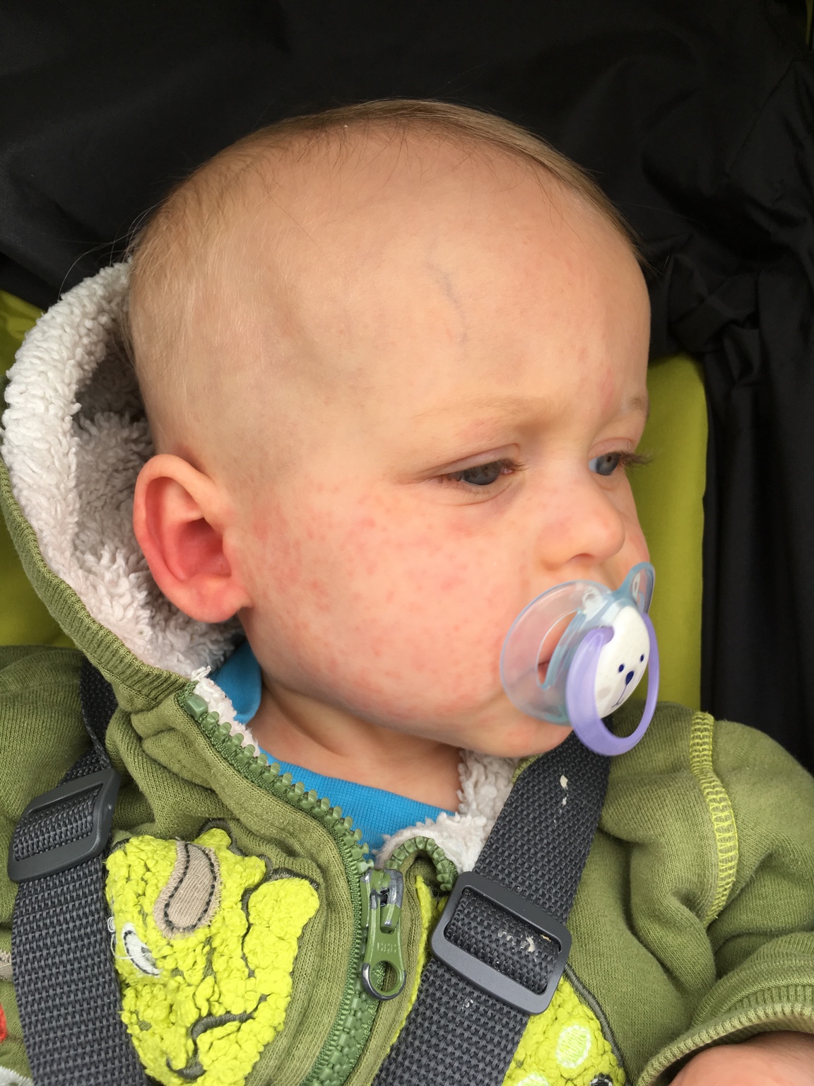 Viral infection rash 10 month old