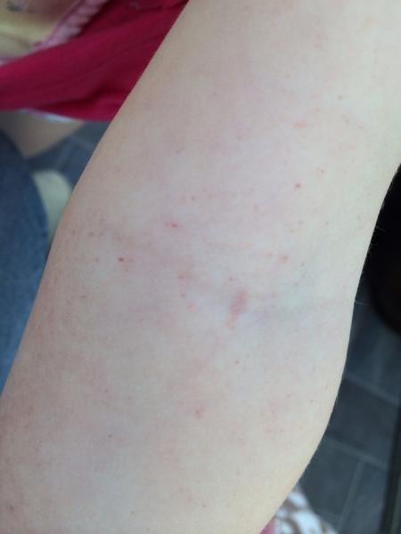 Non blanching rash?