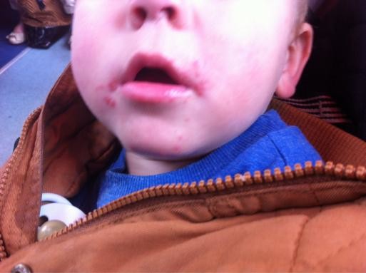 Impetigo Boy Face