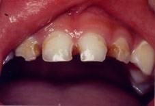 GREY/BLACKISH TWO FRONT TEETH IN THREE YEAR OLD ....