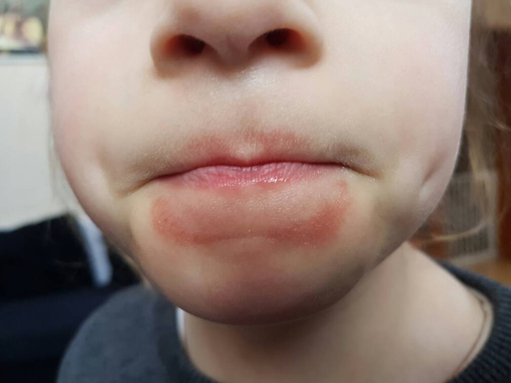 What is this rash?