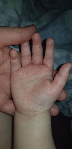 weride rash on palm of 2 year old