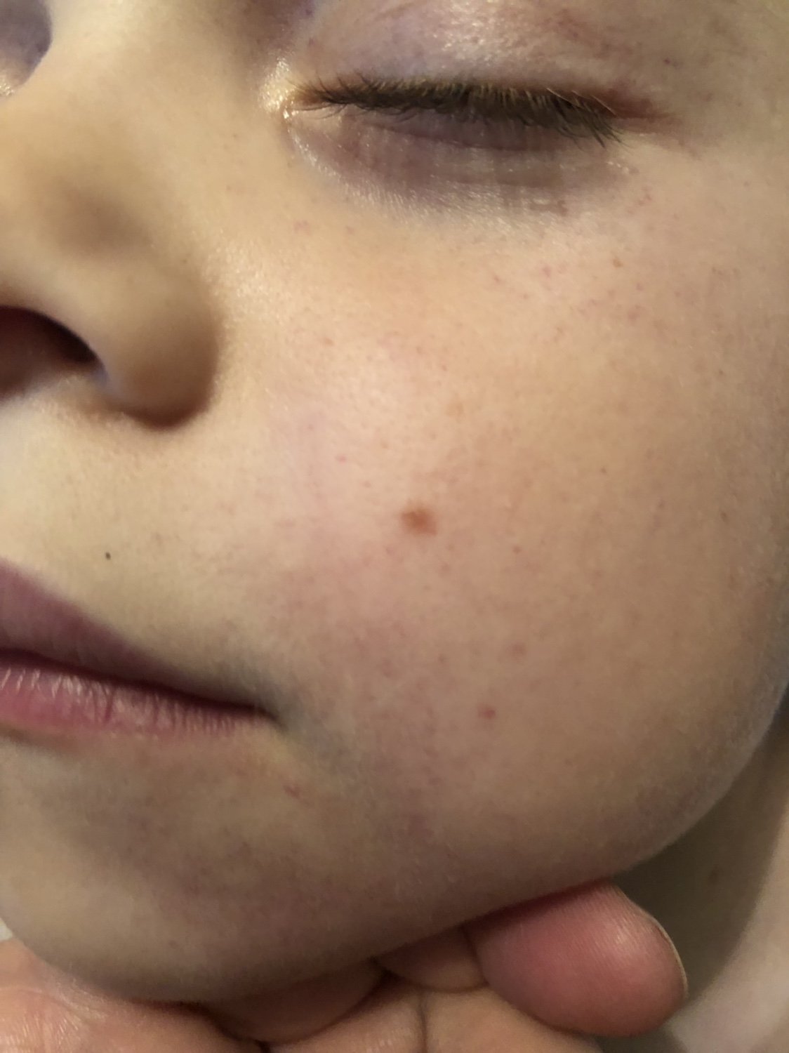 Why Did I Get Red Spots On My Face After Throwing Up Infoupdate Why Did I Get Red Spots On My Face After Throwing Up Infoupdate