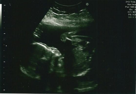 20 Week Scan Thursday Boy Or Girl Any Guesses 20-week-scan-thursday-boy-or-girl-any-guesses