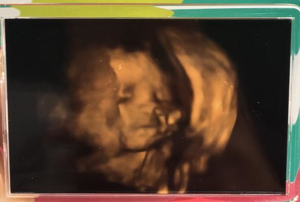 4d scan with an anterior placenta and breech baby...
