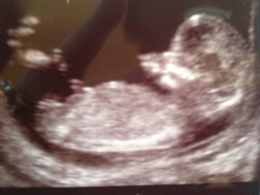 13 week 1 day scan. nub and skull theory = boy or girl