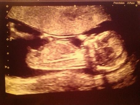 13 week's scan, boy/girl nub :-)