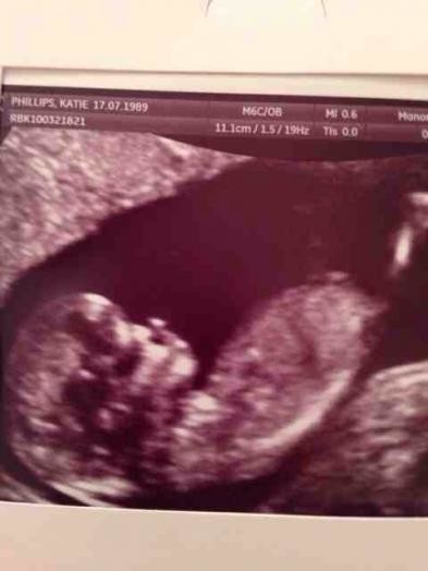 13 week's scan, boy/girl nub :-)