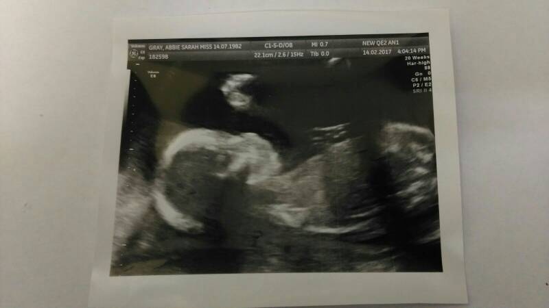 20 week scan pictures
