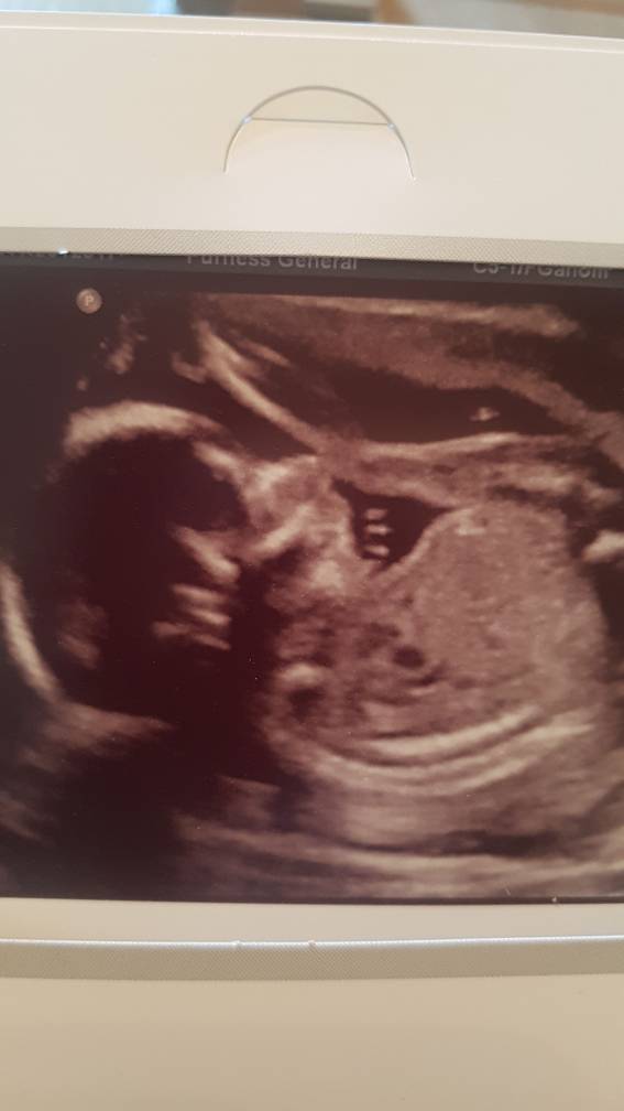 20 week scan pictures