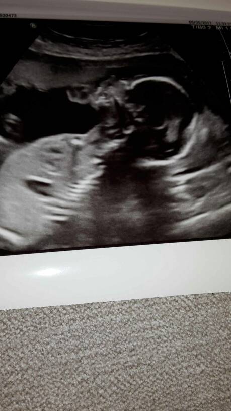 20 week scan pictures