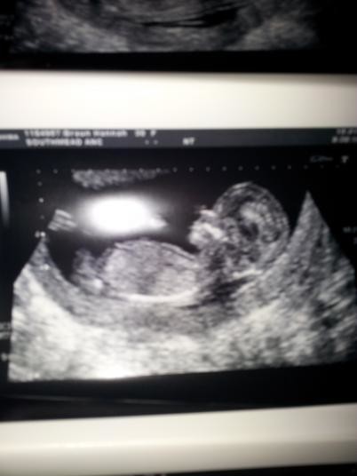 13 weeks Scan Picture - Skull Theory Gender Prediction - what do you think?