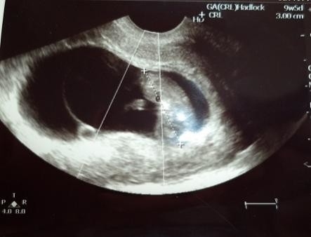 What does a 8 week scan look like..