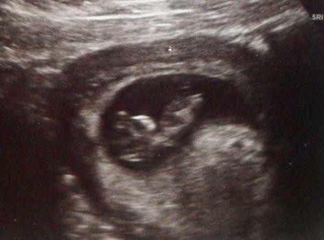 10 week scan picture! Can I see an arm?