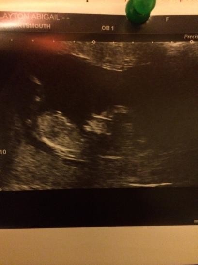 12 week scan - gender guesses