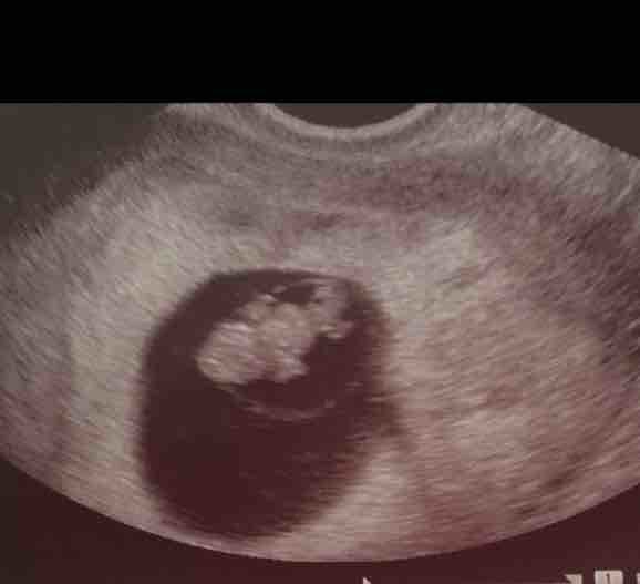 8 +6 weeks scan, what can be seen?