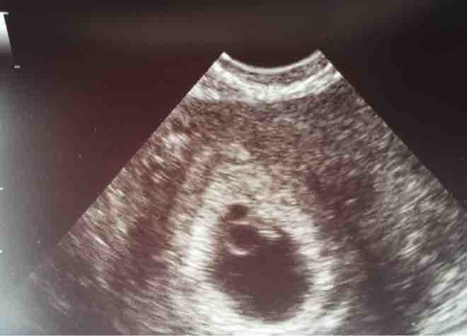 Scan at 6 weeks