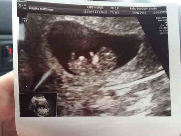 Private scan at 9.5 weeks