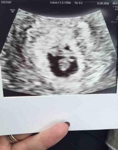 Scan pics 5-7 weeks???
