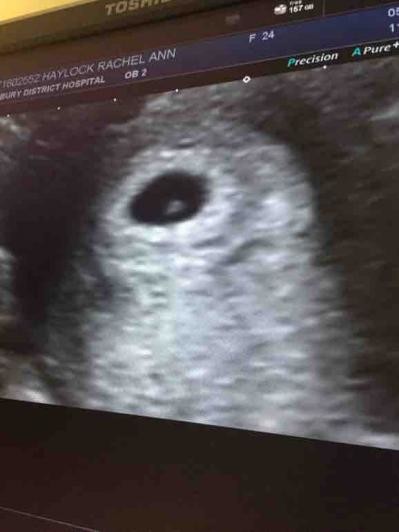 Scan pics 5-7 weeks???