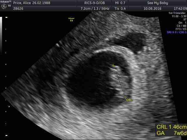 Bleed shown on early scan - advice