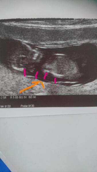 High Nuchal Translucency result at 12 week scan!