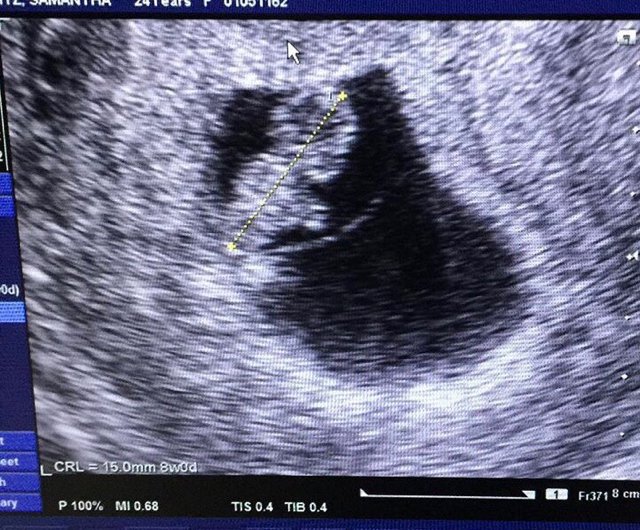Ultrasound scans at 8 weeks pics. - Page: 4