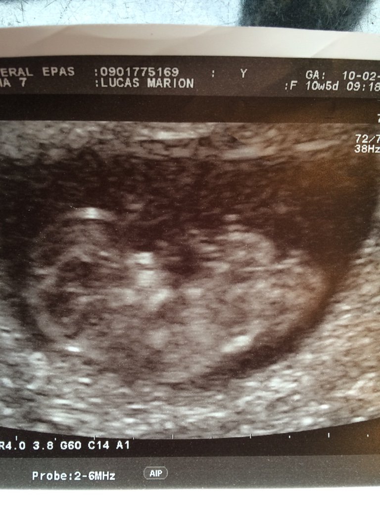 Ultrasound scans at 8 weeks pics. - Page: 2
