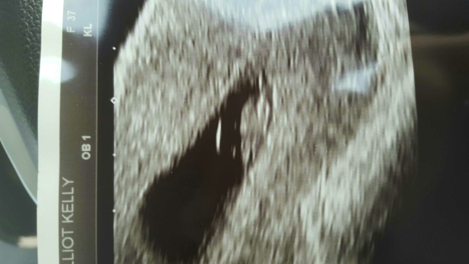 Ultrasound scans at 8 weeks pics. - Page: 4