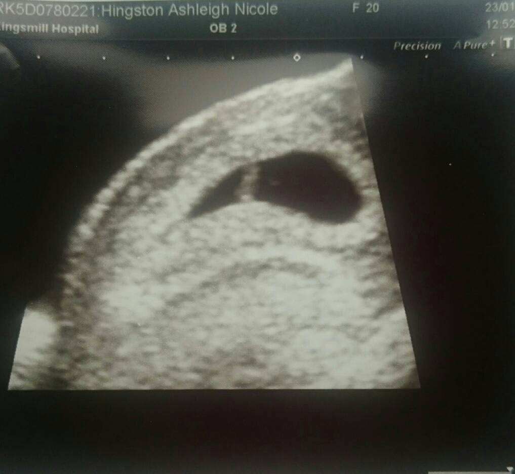Ultrasound scans at 8 weeks pics. - Page: 2