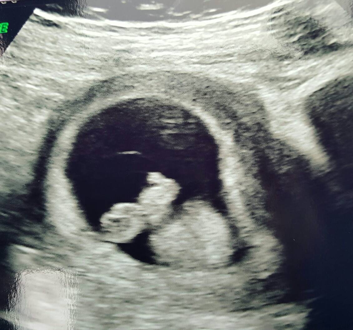 Ultrasound scans at 8 weeks pics. - Page: 4