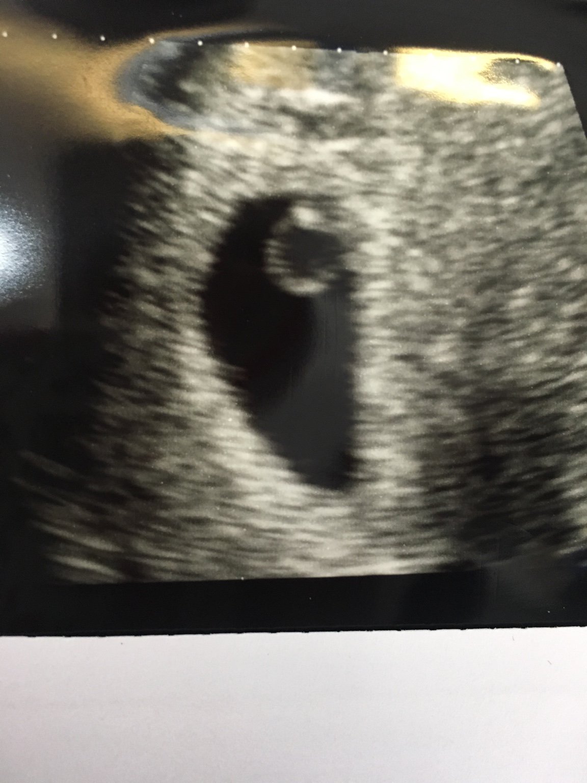 Ramzi theory 6 weeks scan