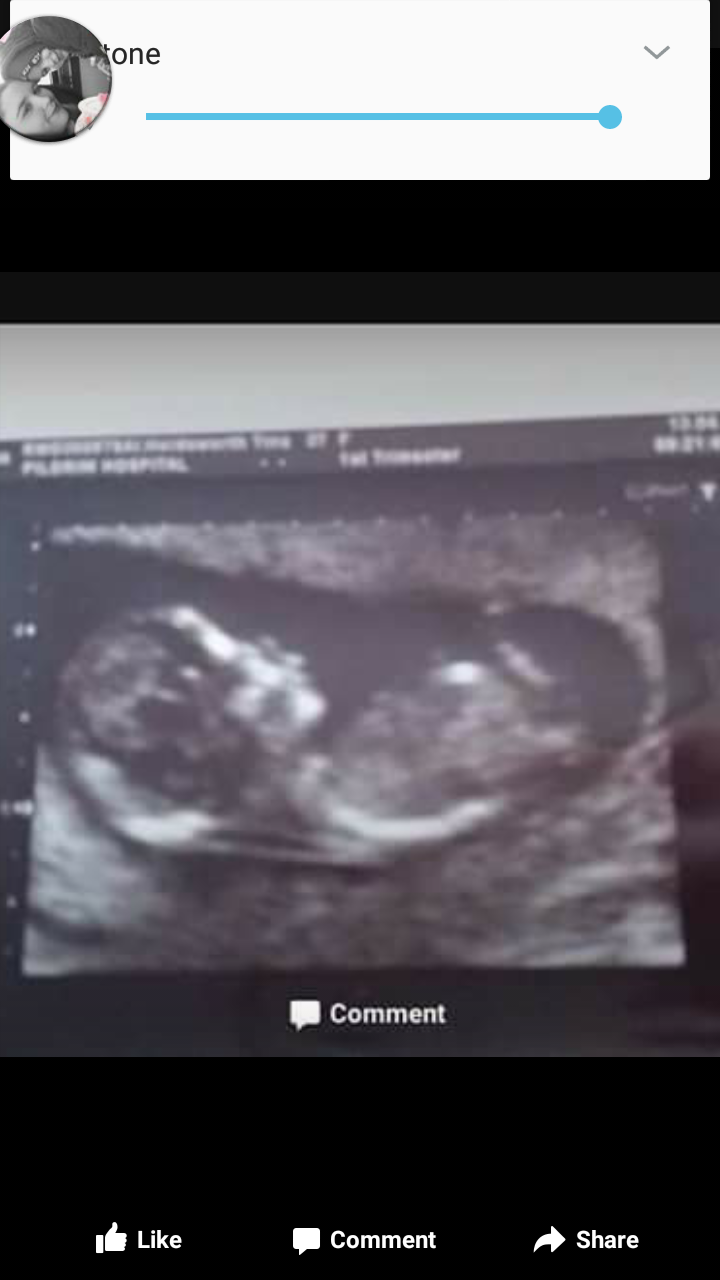 Early scan pictures