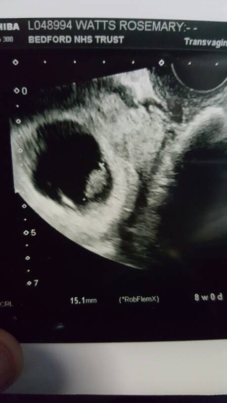 Early scan pictures