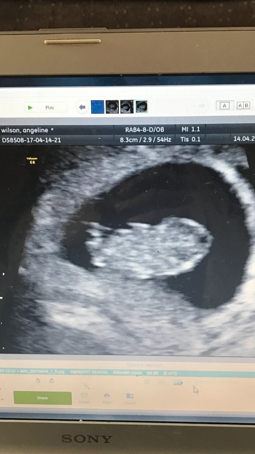 Early scan pictures
