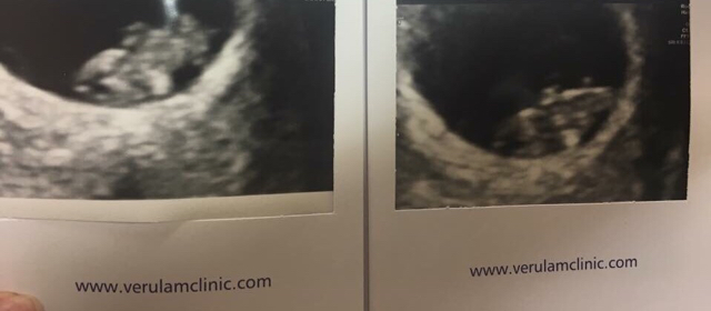 Early scan pictures