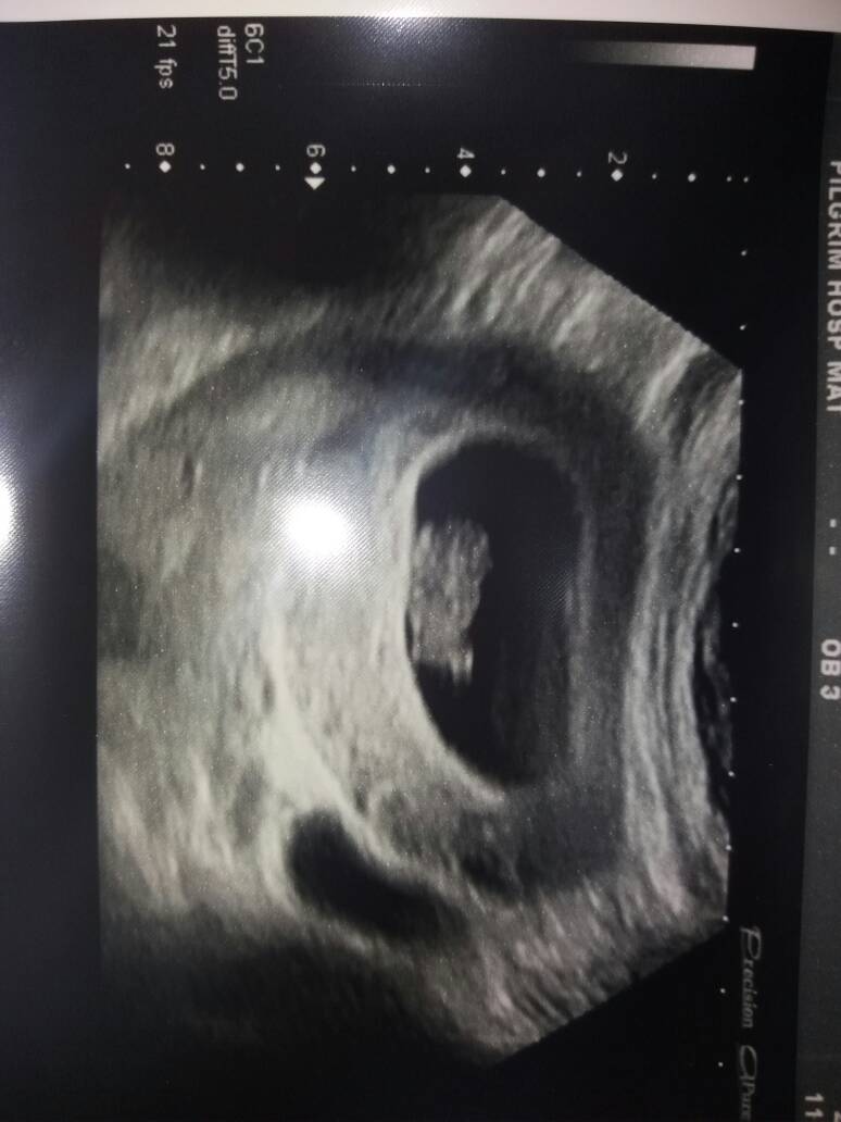Early scan pictures