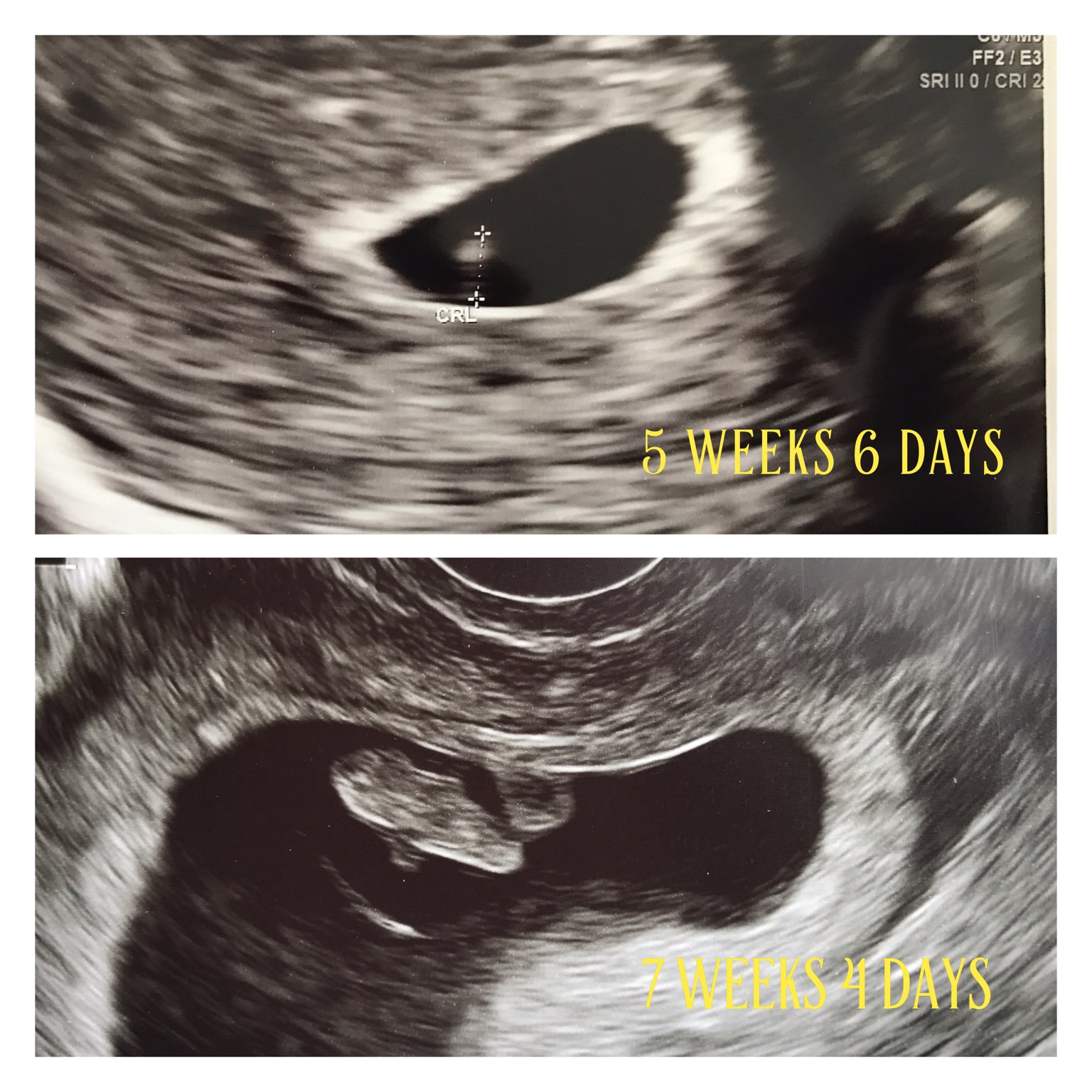 Anyone had a scan at 6 or 7 weeks? Was it worth it/ re-assuring? - Page: 2