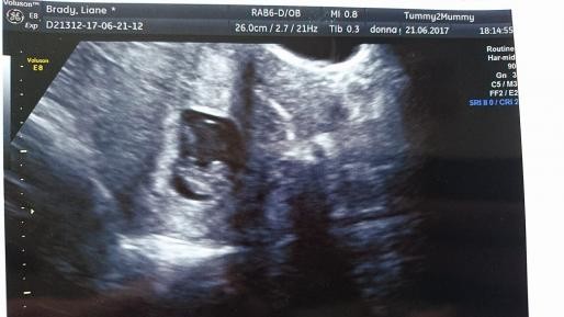 8 Weeks Scans - Can i see your pictures please - Page: 3
