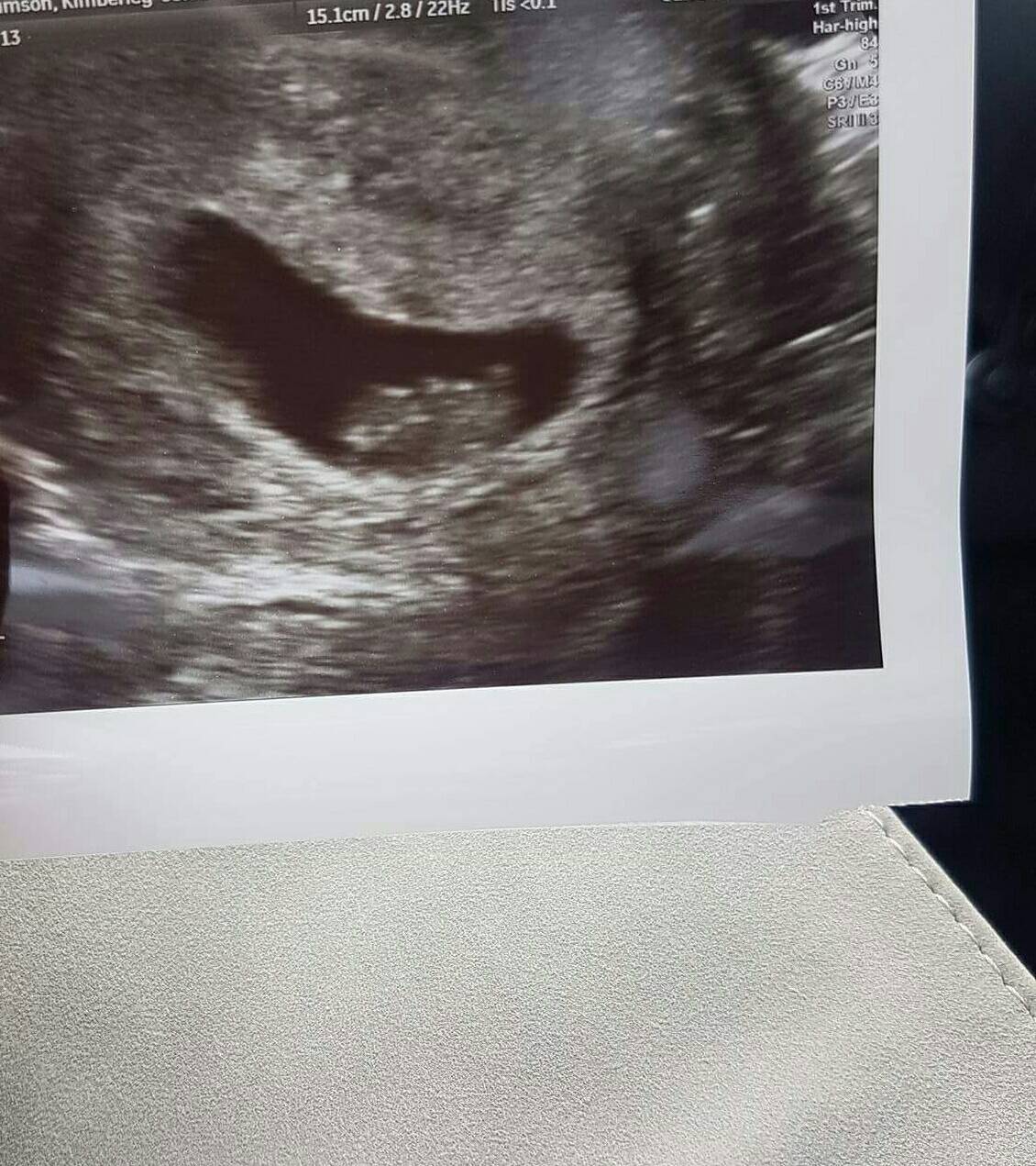 8 Weeks Scans - Can i see your pictures please - Page: 2