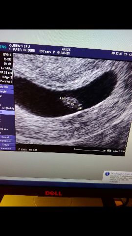 Booked early scan for 9 weeks. Will I see anything or stress myself out ...
