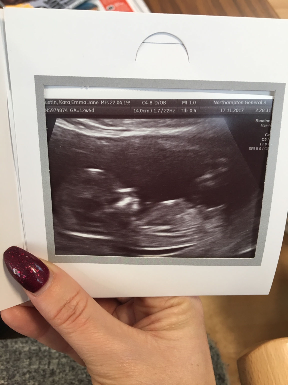 13 week scan boy or girl x