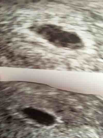 Early Pregnancy Scan at 5 weeks but empty sac