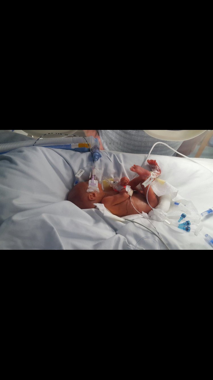 Twin boys born at 24 weeks