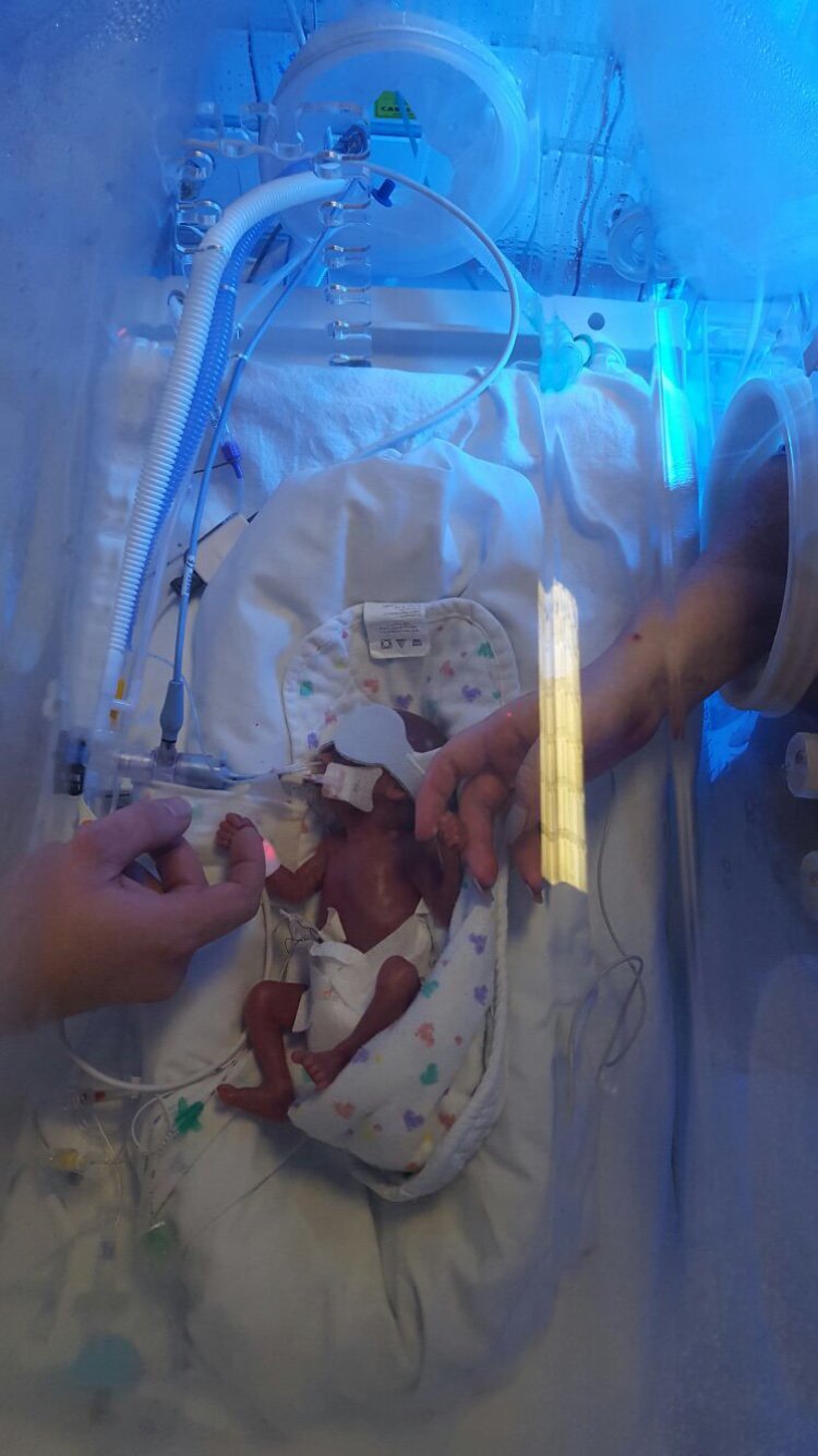 Twin boys born at 24 weeks